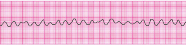 PALS Algorithms 2023 (Pediatric Advanced Life Support)